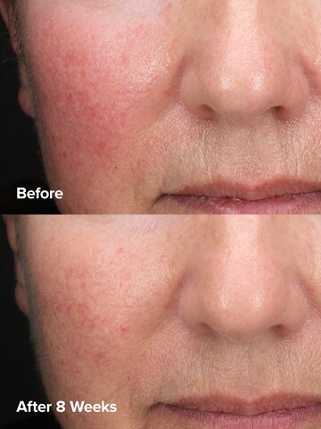 6% Mandelic Acid + 2% Lactic Acid Liquid AHA Exfoliant | Paula's Choice ...