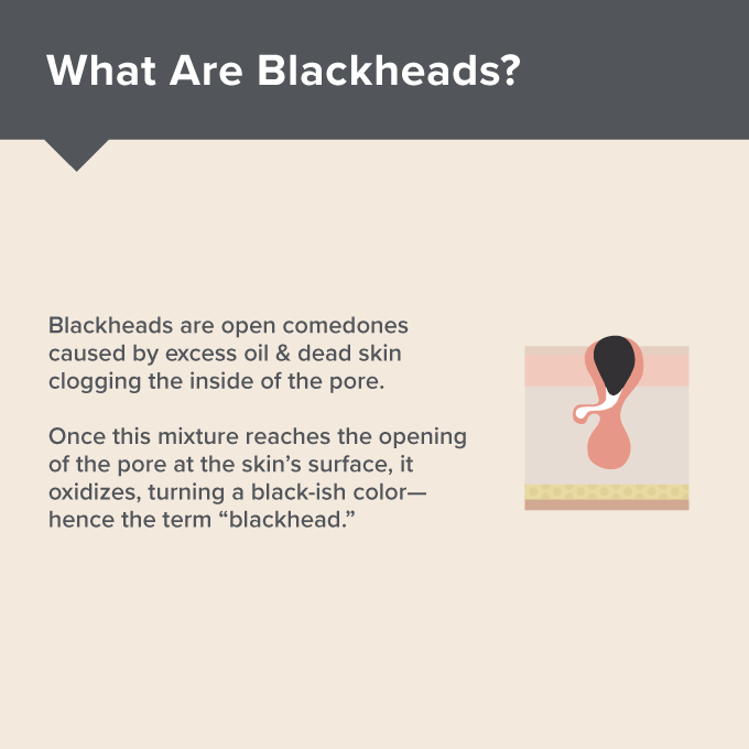How to Prevent and Get Rid of Blackheads | Paula's Choice Australia